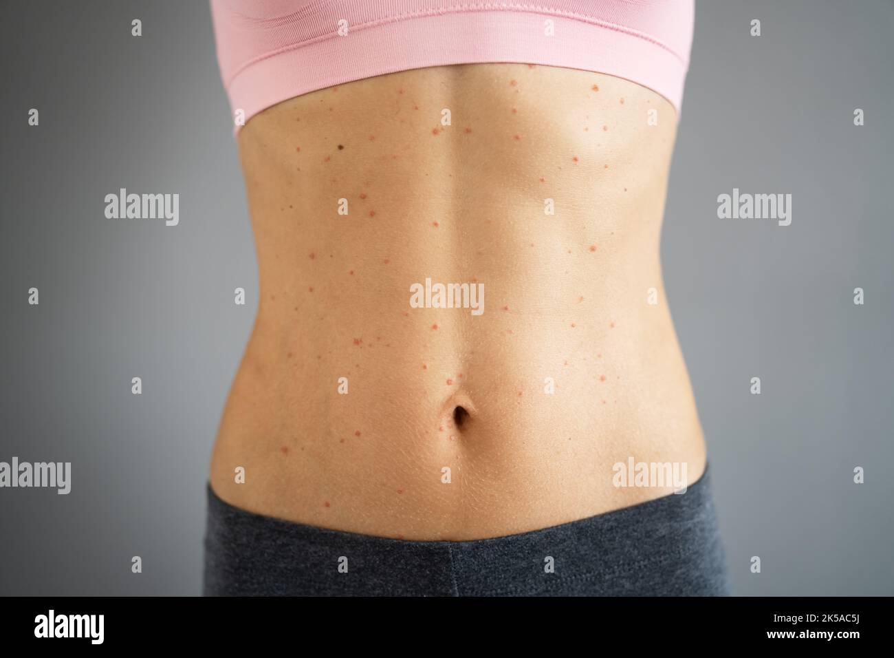 Woman Body Skin Rash With Red Allergy Eruption Stock Photo - Alamy