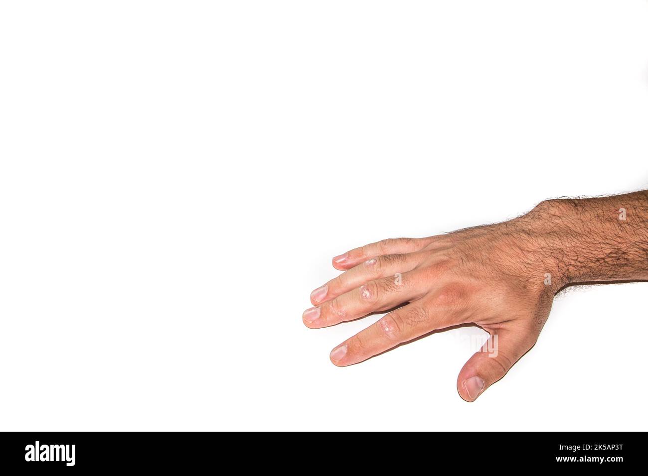 A Caucasian male showing his hand affected by psoriasis - a skin ...