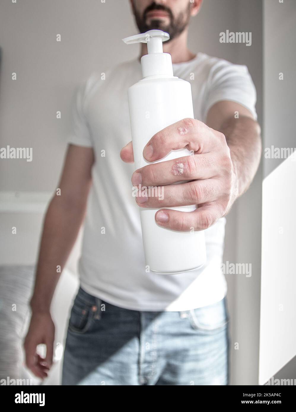 A Caucasian male with psoriasis - a skin condition, holding medicine in ...