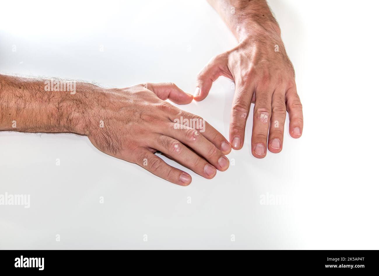 Psoriasis affected skin hi-res stock photography and images - Alamy