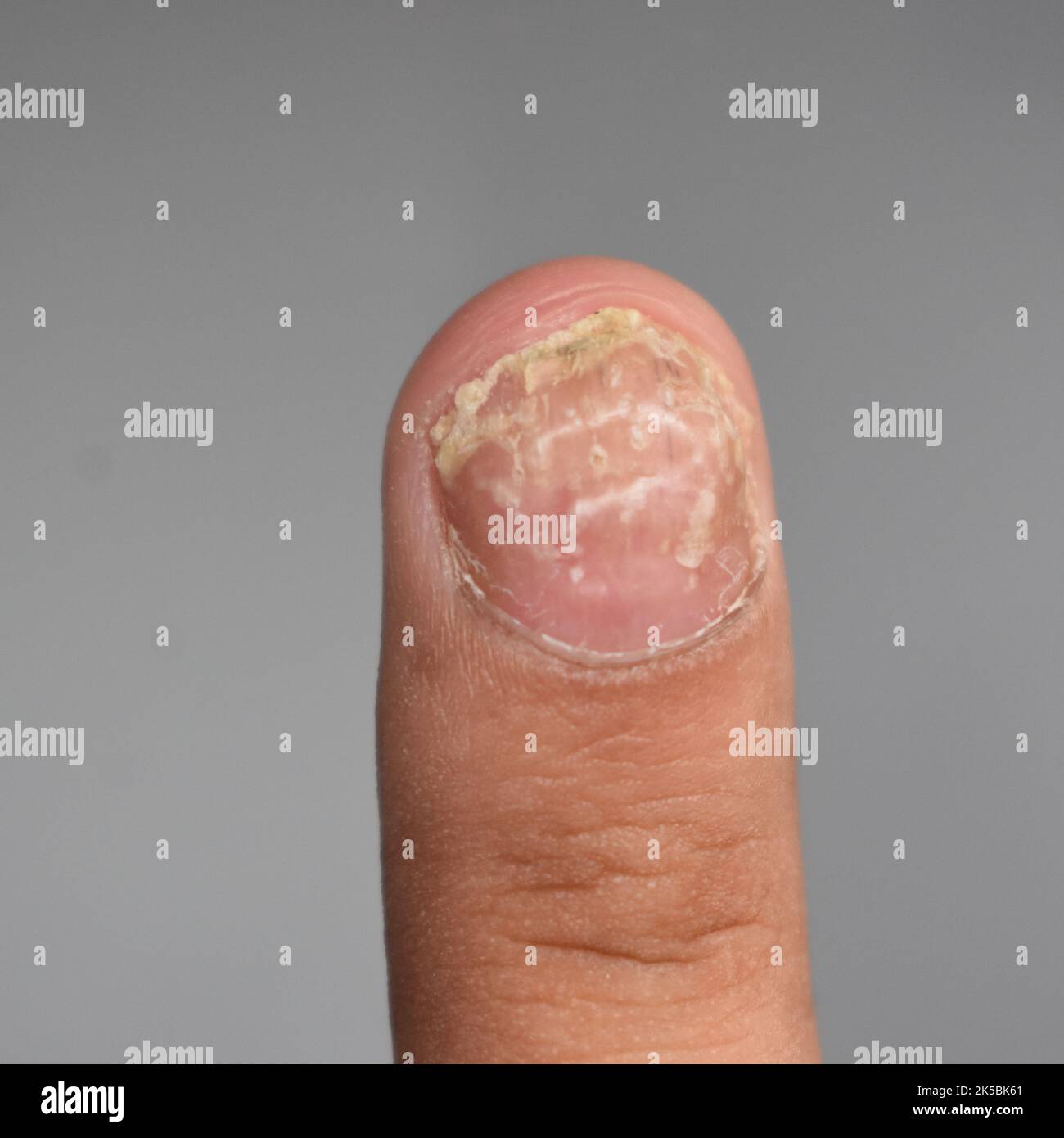 Damage finer with white background. This is a damaged nail finger Stock ...