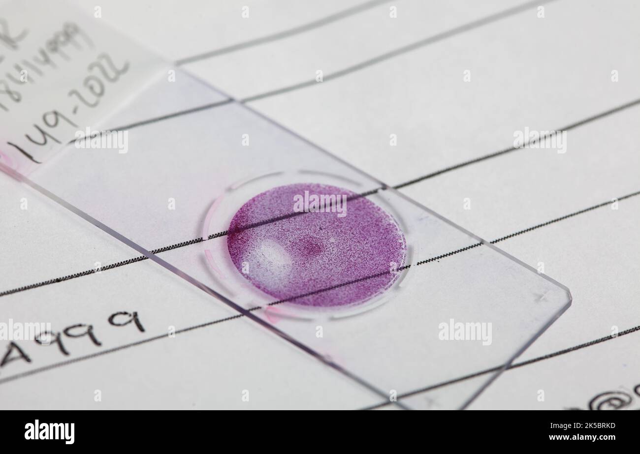 Liquid based cytology microscope slide for pap smear test. Cervical ...