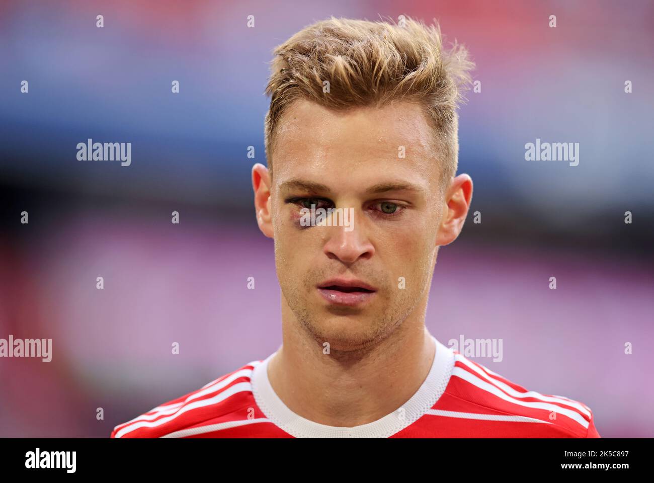 Joshua Kimmich of Bayern Muenchen mit blauen Auge FC Bayern Muenchen ...