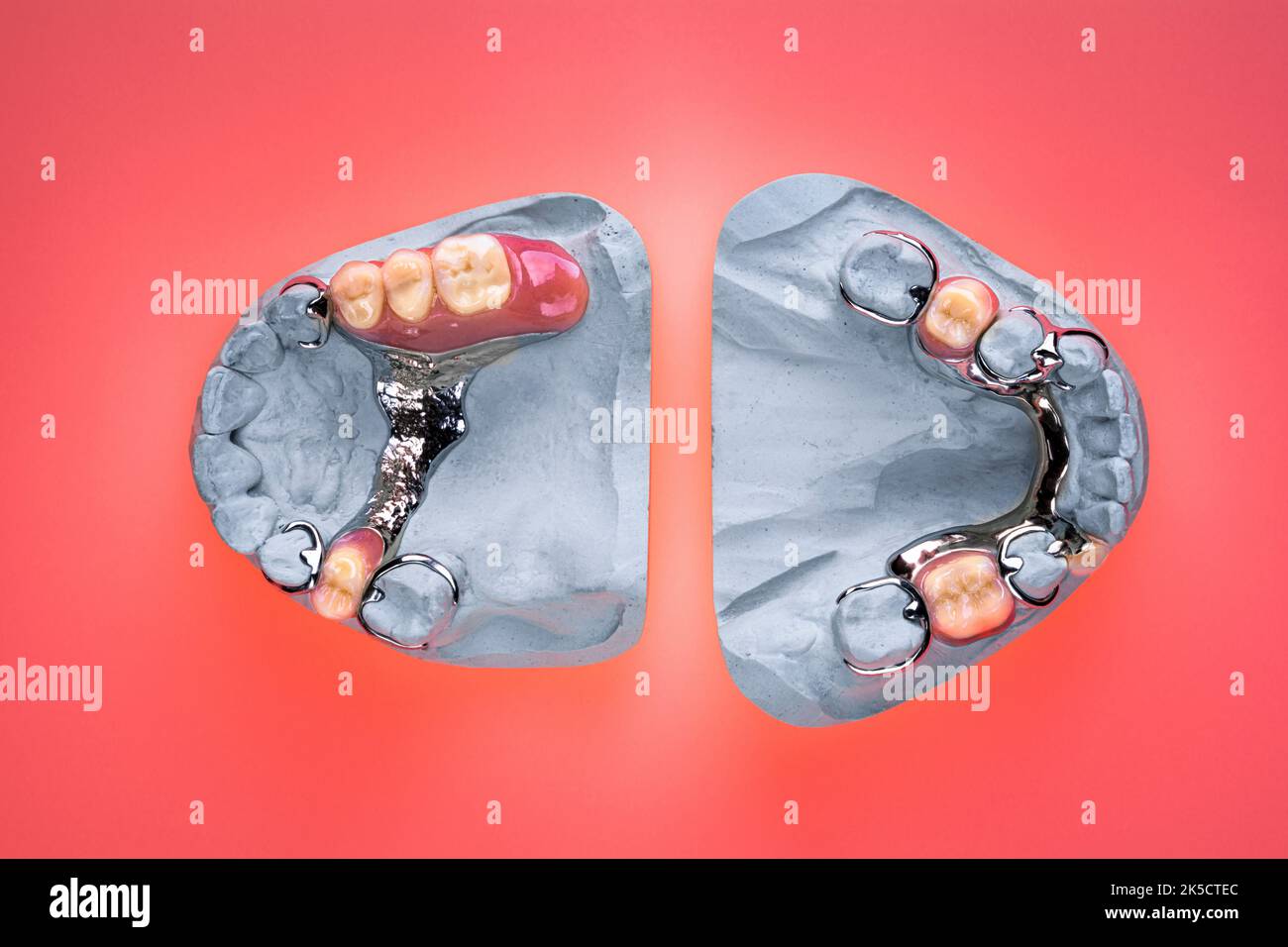 Dentures, partial dentures on plaster model Stock Photo - Alamy