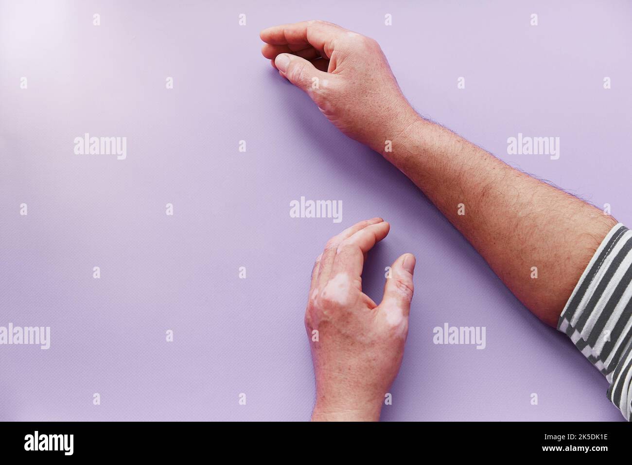 Vitiligo disease man's hands on purple background. Skin pigmentation ...