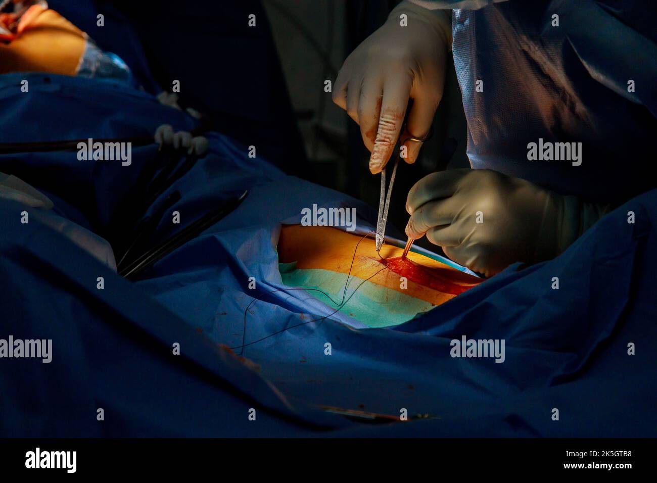 During the operation, doctors are seen securing wound a leg after it ...