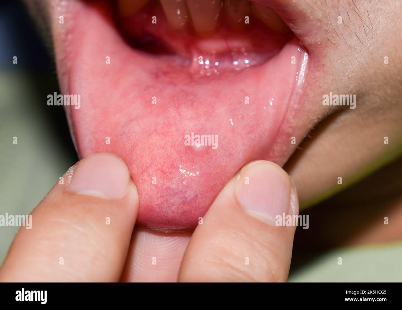 Lesion oral hi-res stock photography and images - Alamy