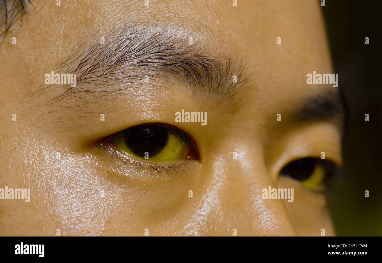 Deep jaundice in Asian male patient. Yellowish discoloration of skin ...