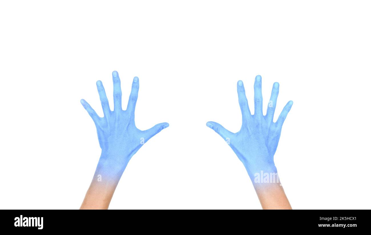 Cyanosis skin hi-res stock photography and images - Alamy