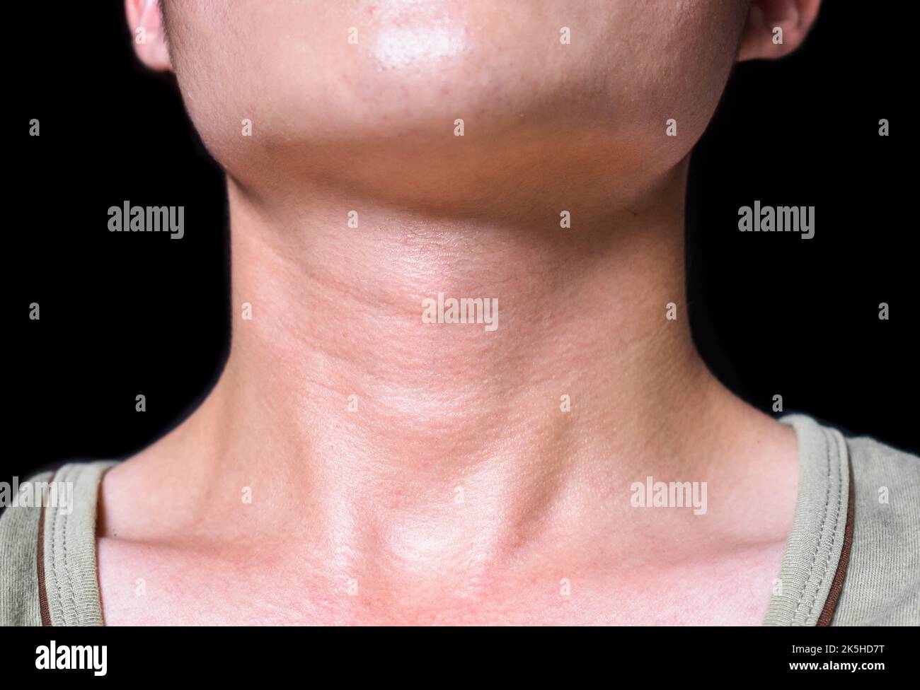 Aging skin folds or skin creases or wrinkles at neck of Southeast Asian ...