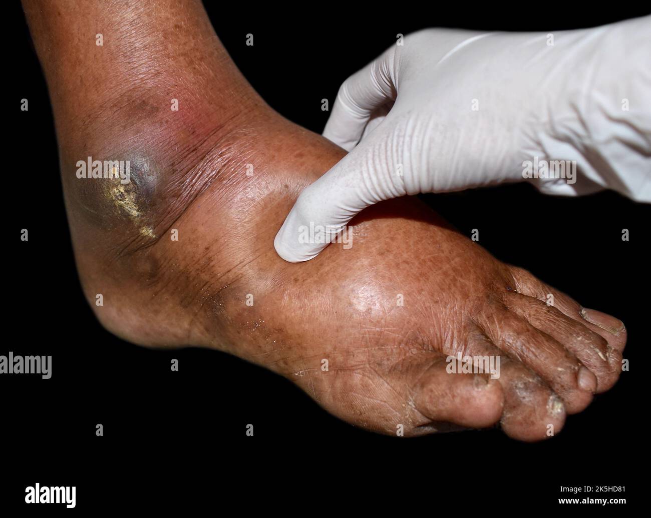 Pitting Edema In Dogs