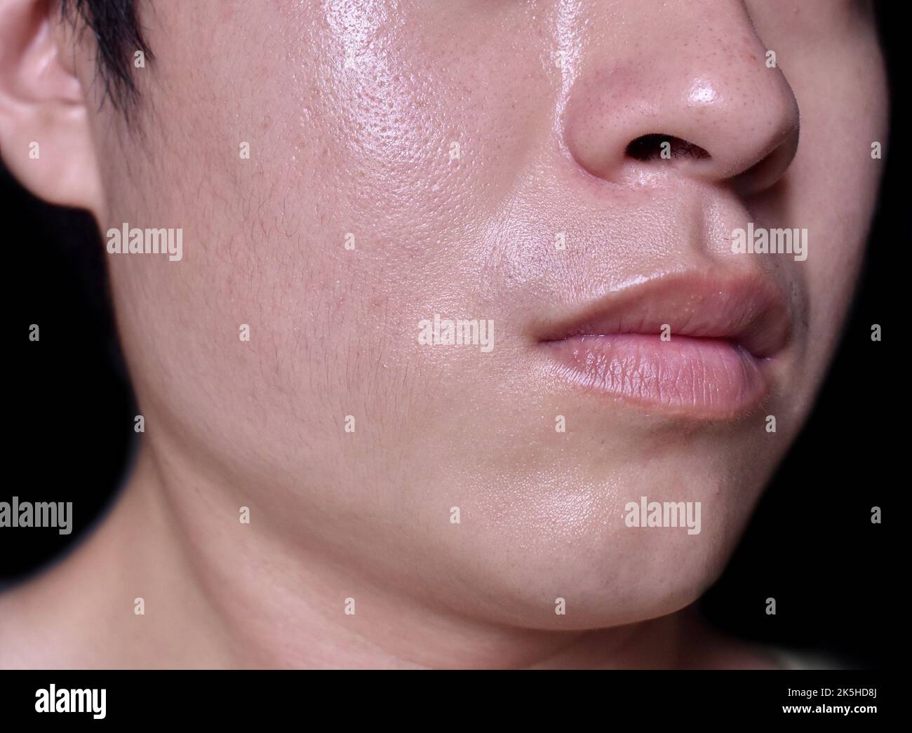 Oily face of Southeast Asian, Myanmar or Korean adult young man Stock ...