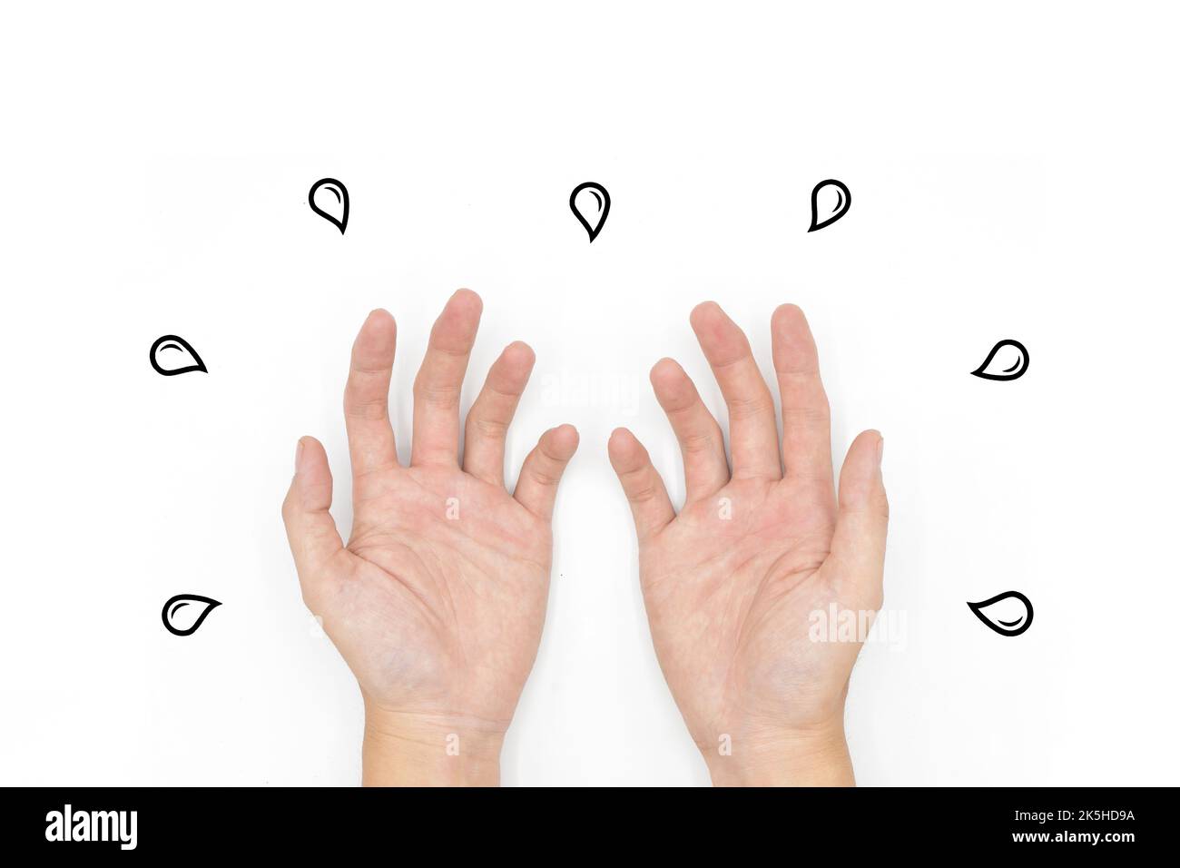 Palmar aspect of sweaty and oily hands. Sweating palms. Isolated on white background Stock Photo ...