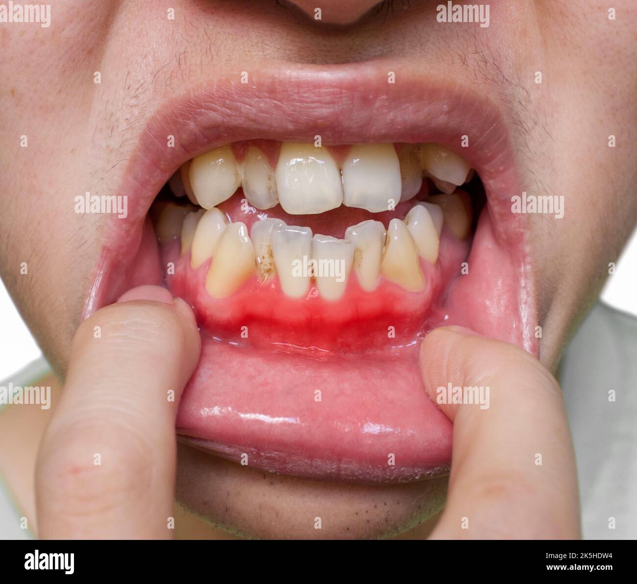 Inflammation of gum called gingivitis. Periodontal problem. Poor oral ...