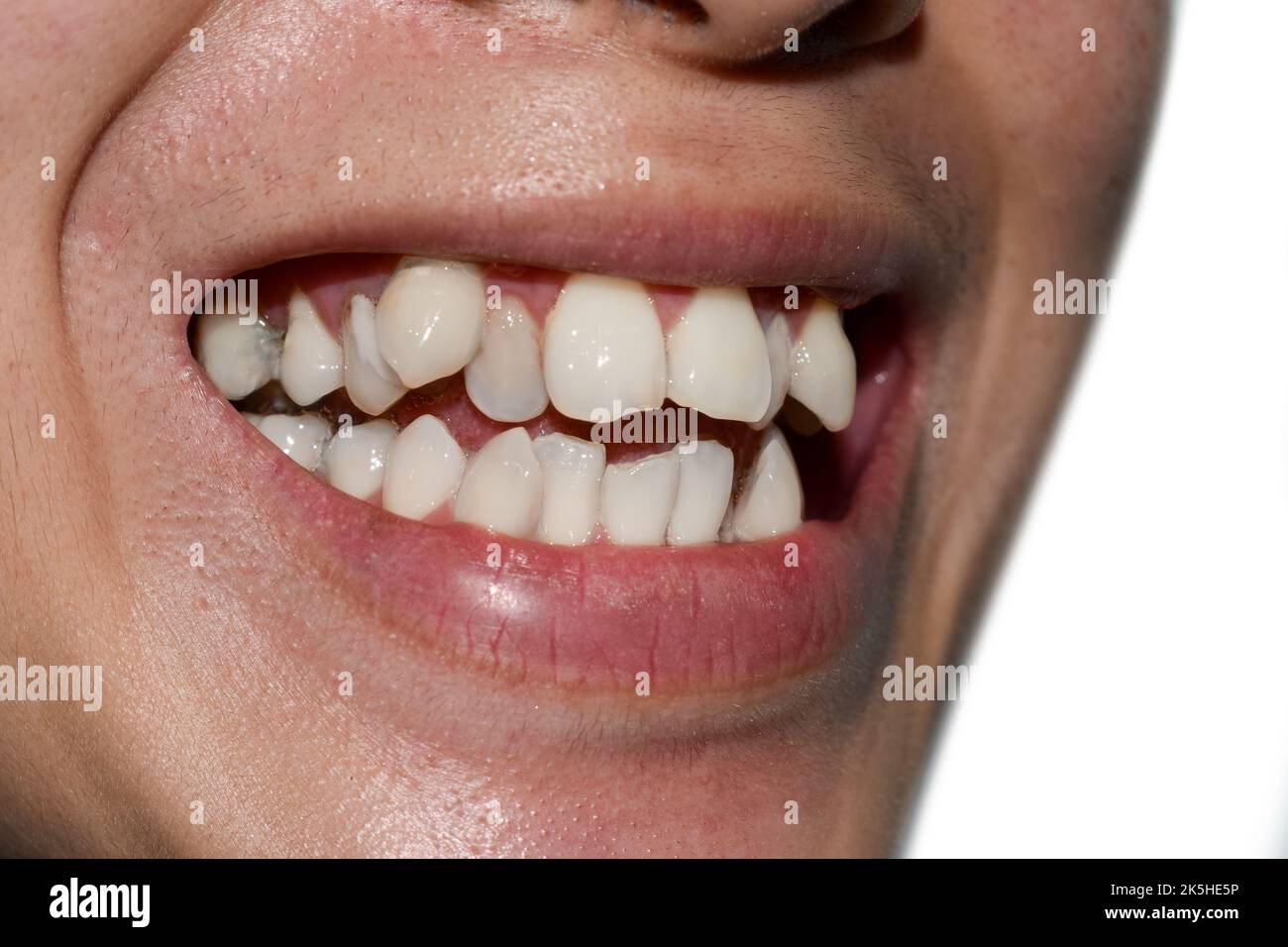 Stacked or overlapping white teeth of Asian man. Also called crowded ...