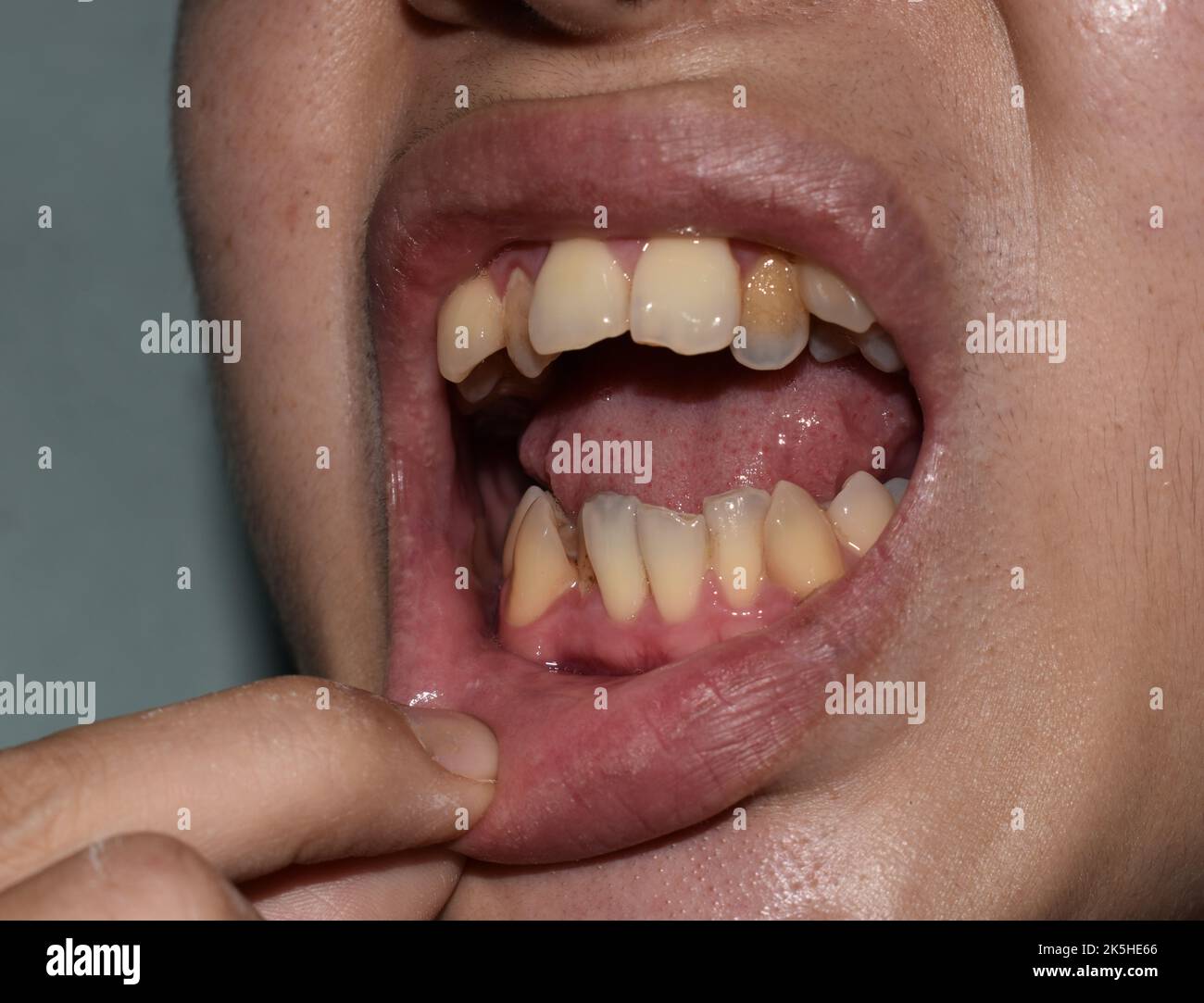 Stacked or overlapping teeth with yellow stain of Asian man. Also ...