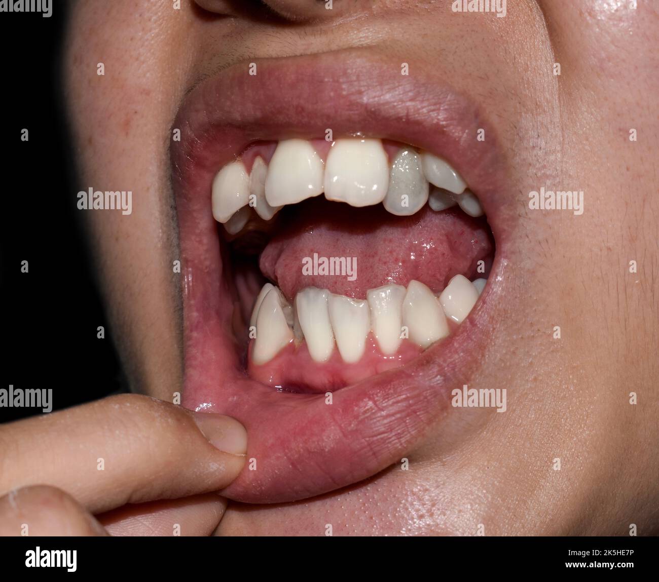 Stacked or overlapping white teeth of Asian man. Also called crowded ...