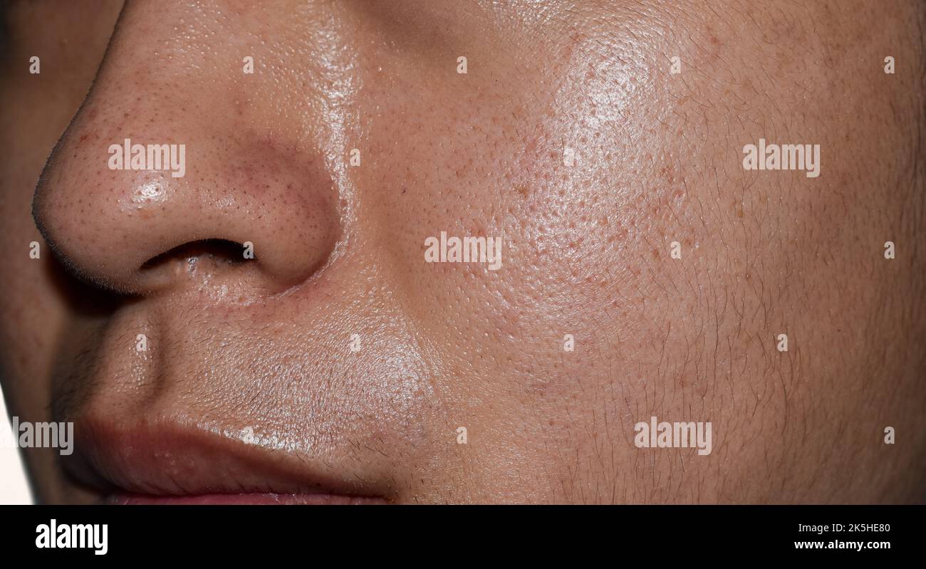 Oily face with wide pores of Southeast Asian, Myanmar or Korean adult ...
