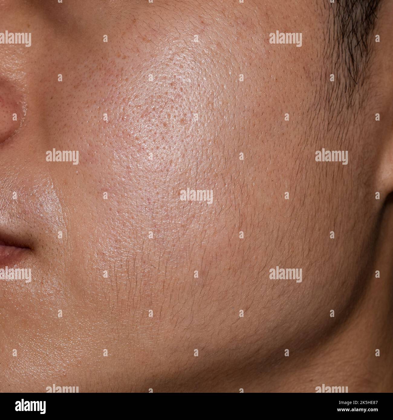 Oily face with wide pores of Southeast Asian, Myanmar or Korean adult ...