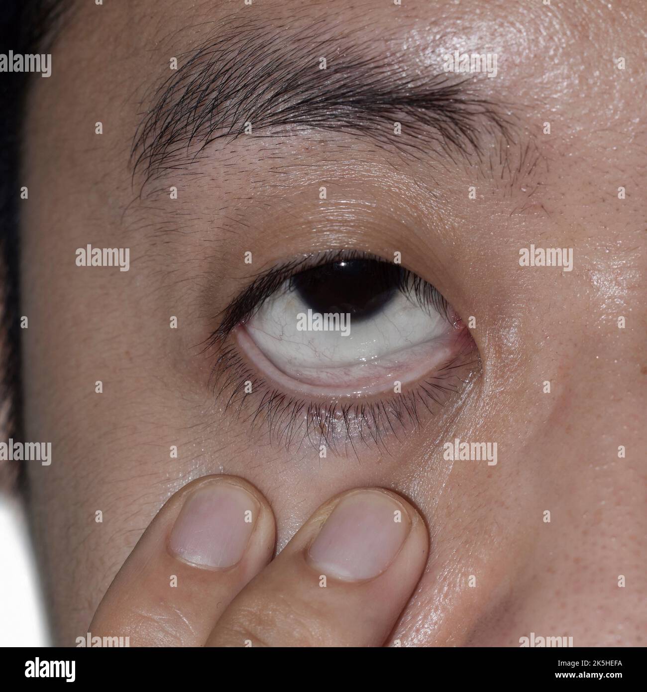 Anemia hi-res stock photography and images - Alamy