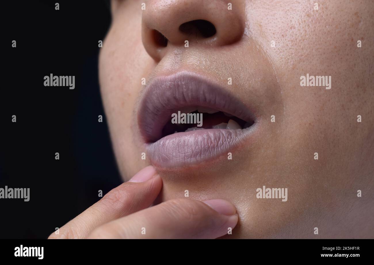 Cyanotic Lips Or Central Cyanosis In Southeast Asian Young Man With Congenital Heart Disease