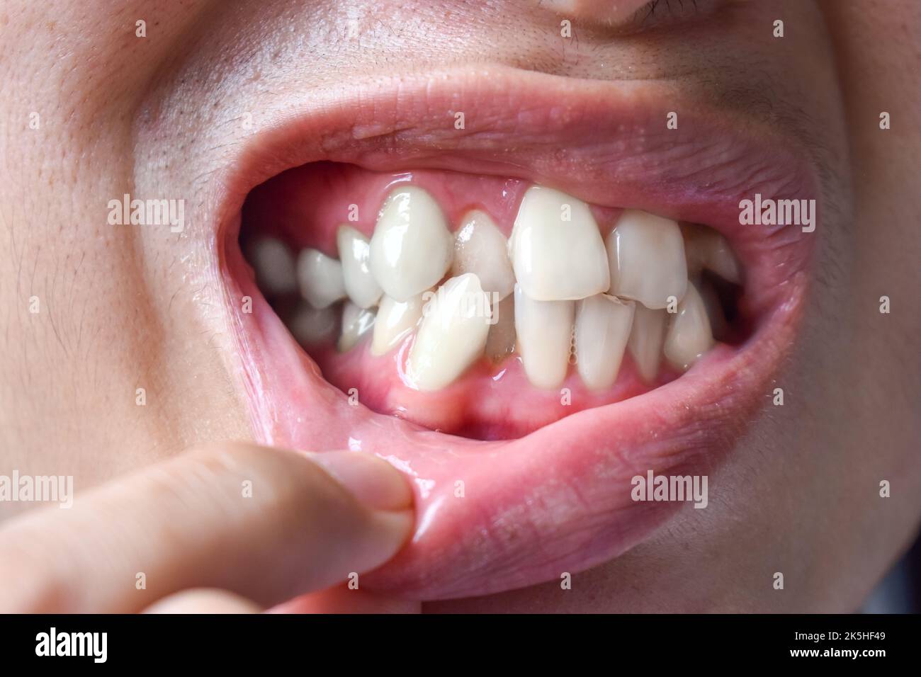 Stacked or overlapping white teeth of Asian man. Also called crowded ...