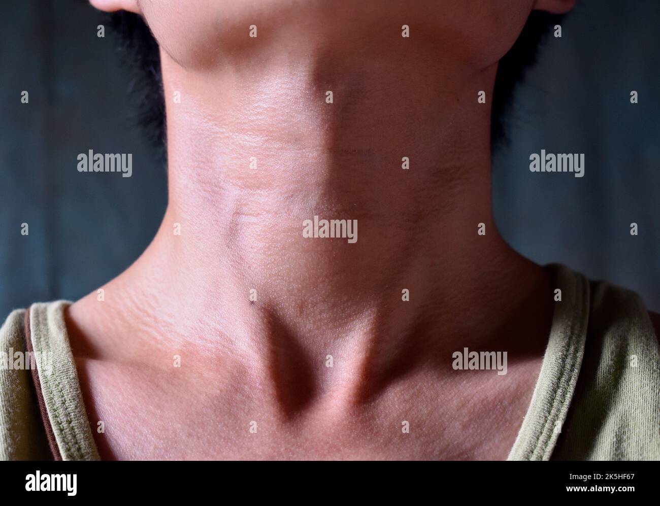 Neck swelling diagnosed as hyperthyroidism. Aging skin folds or skin ...