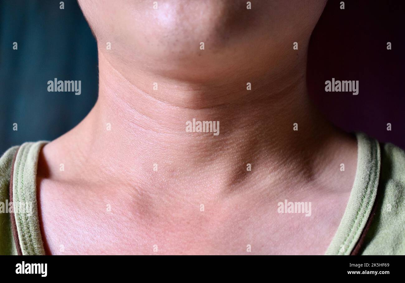 Aging skin folds or skin creases or wrinkles at neck of Southeast Asian ...