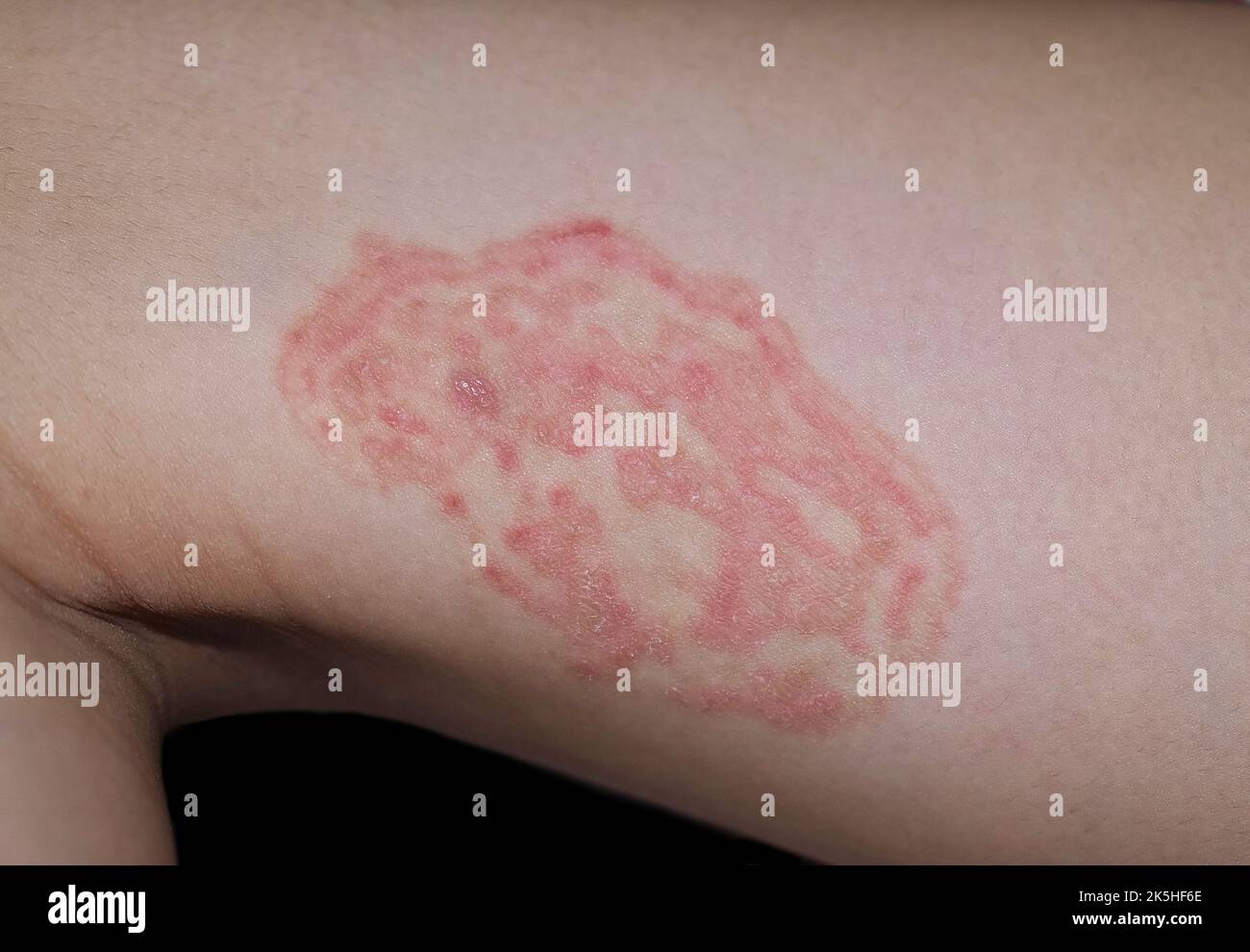 Fungal infection called tinea corporis in thigh of Southeast Asian ...