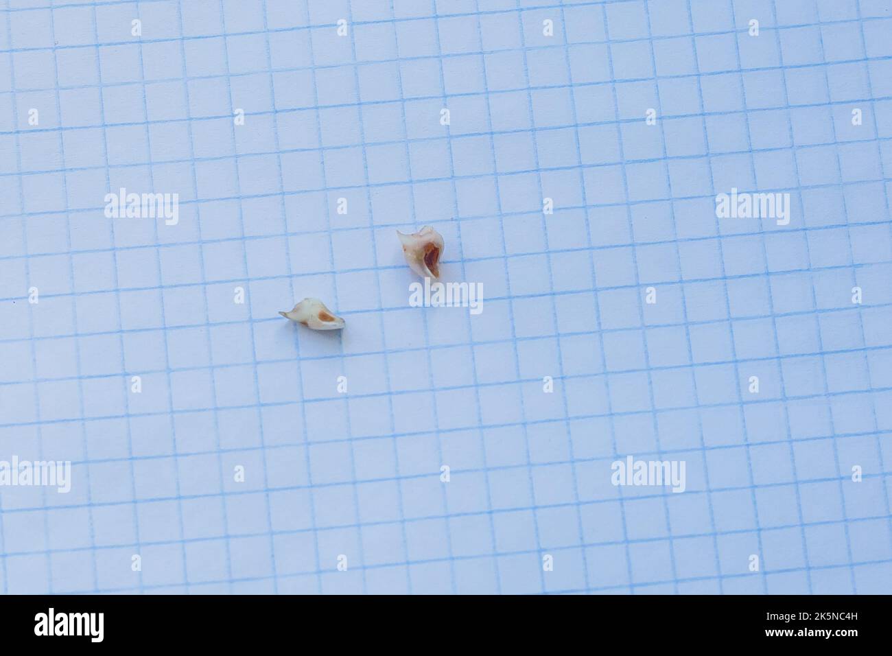 tooth decay. badly decayed extracted teeth Stock Photo - Alamy