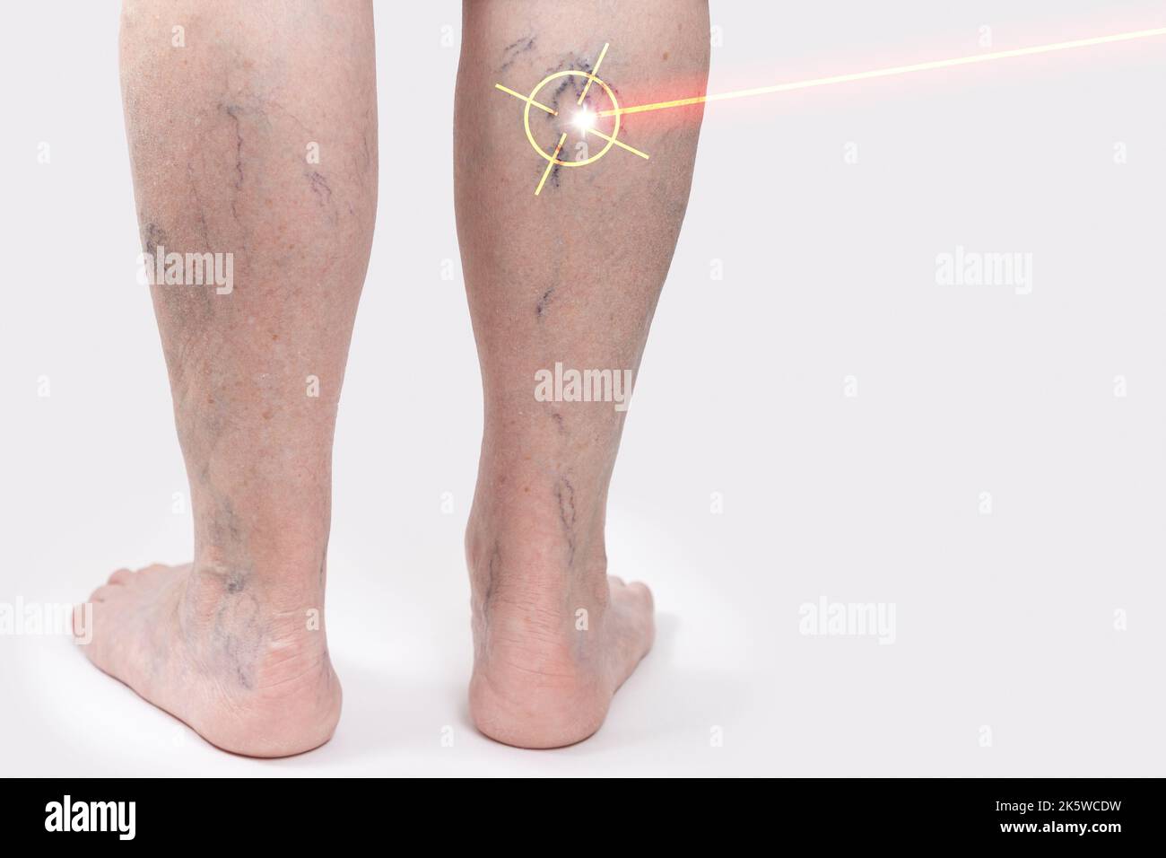 Varicosity and laser treatment. Close up of old legs of woman with ...