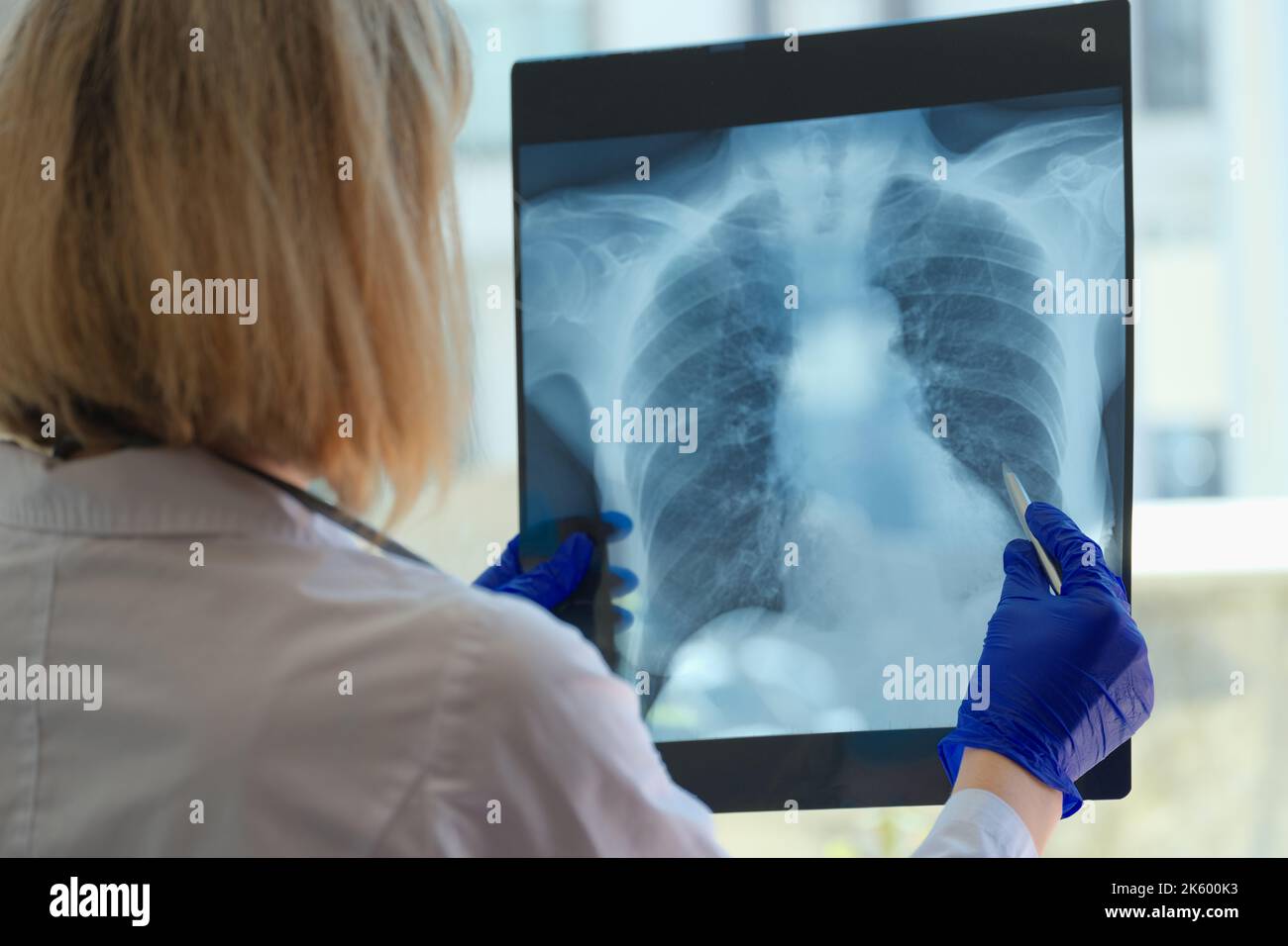 Doctor pulmonologist looking at x-ray shoot of lungs Stock Photo - Alamy