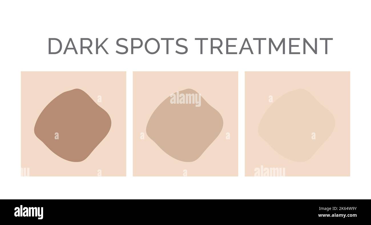 Scar removal laser color Stock Vector Images - Alamy