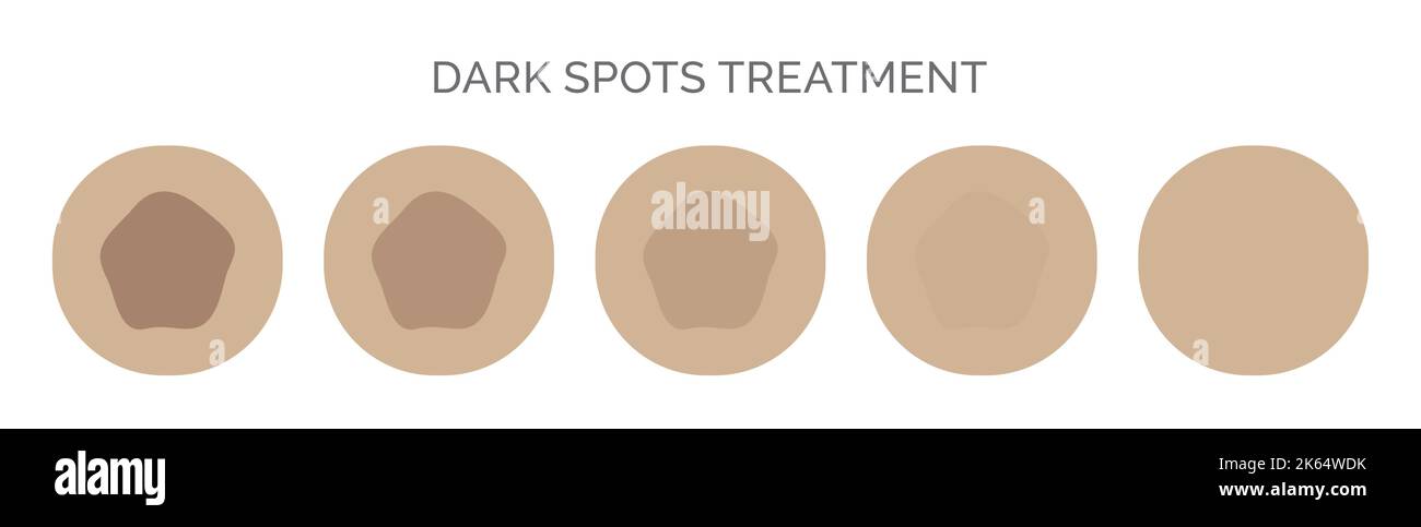Dark Spots Treatment Illustration Stock Vector Image & Art - Alamy