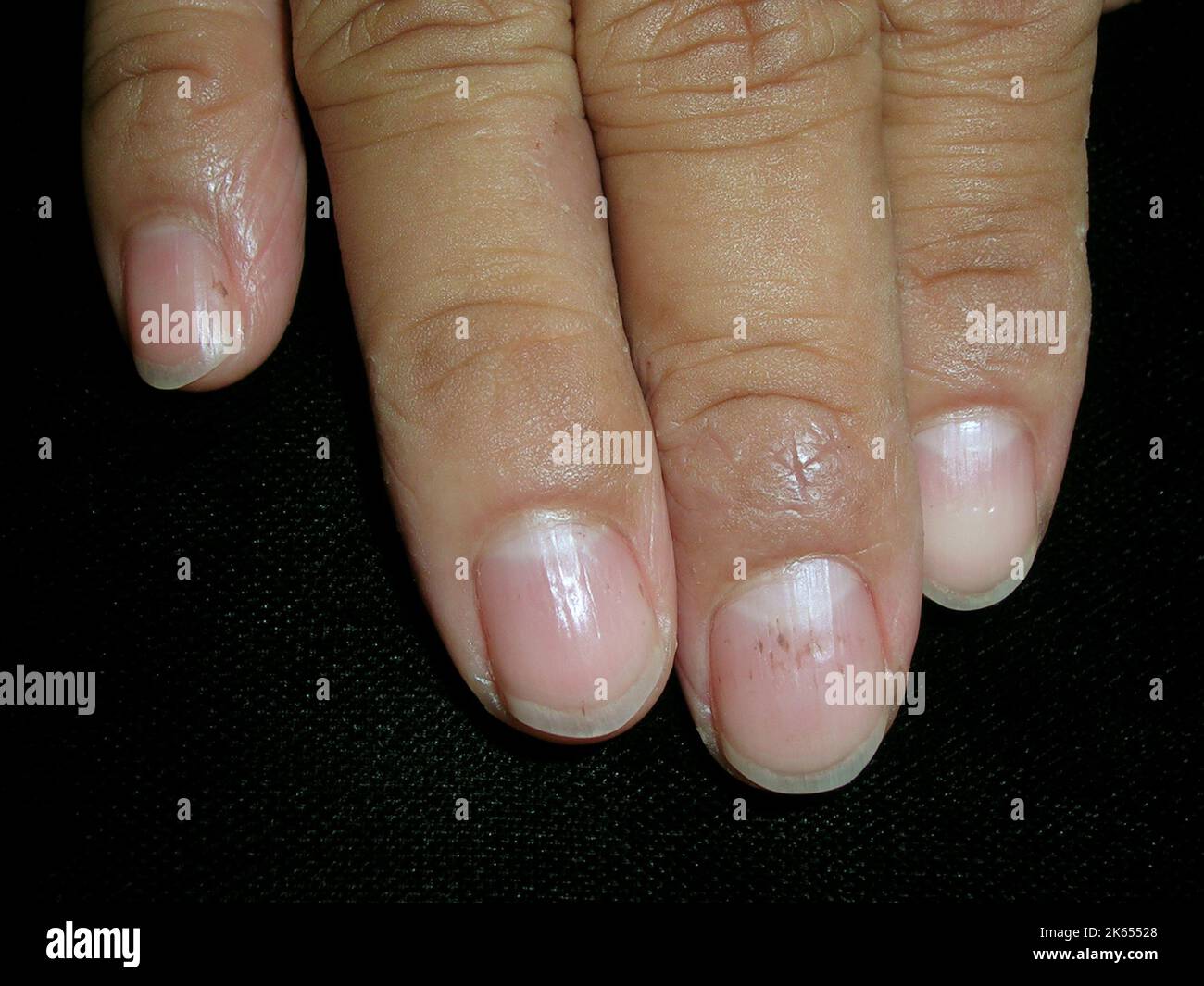 Pitted nails due to severe atopic dermatitis Stock Photo - Alamy