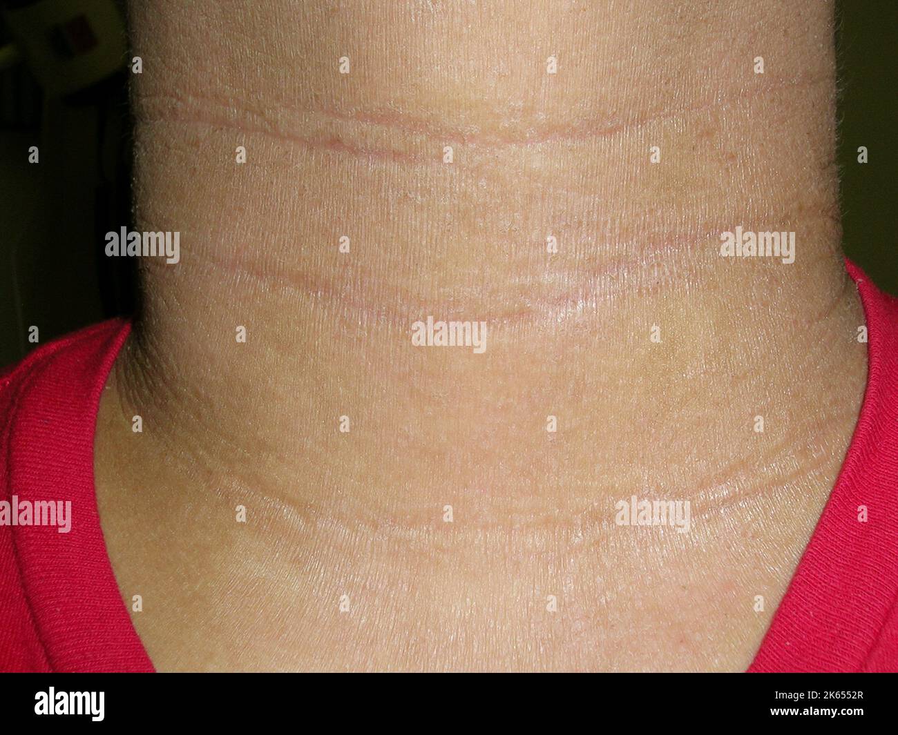 Hyperlinear skin in atopic dermatitis Stock Photo - Alamy