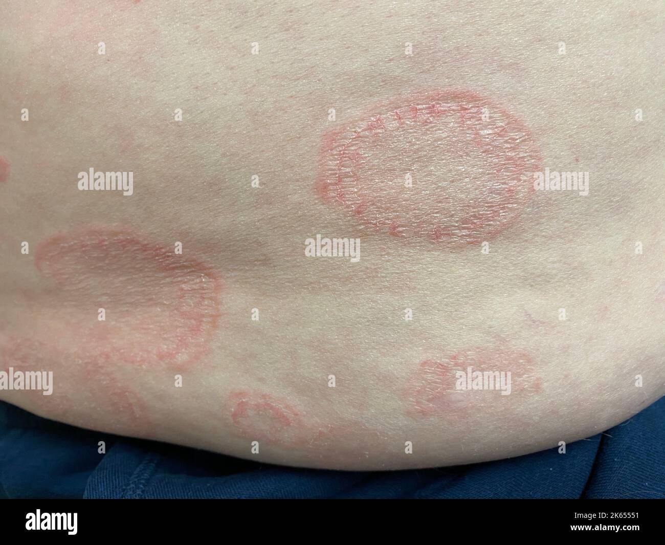 Erythema annulare centrifugum Stock Photo - Alamy