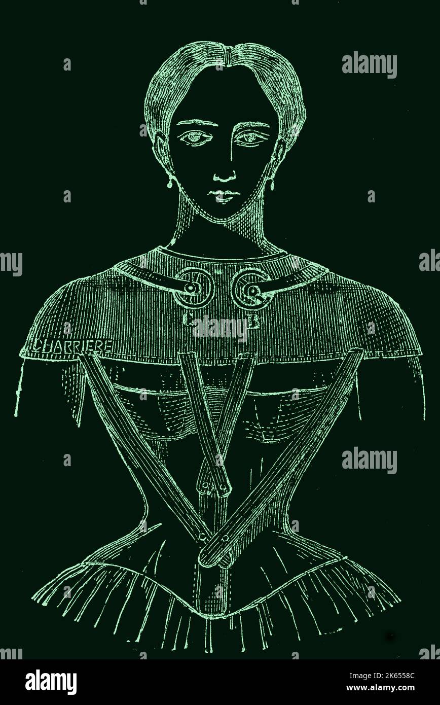 Instrument to hold clavicle dislocation, illustration Stock Photo - Alamy