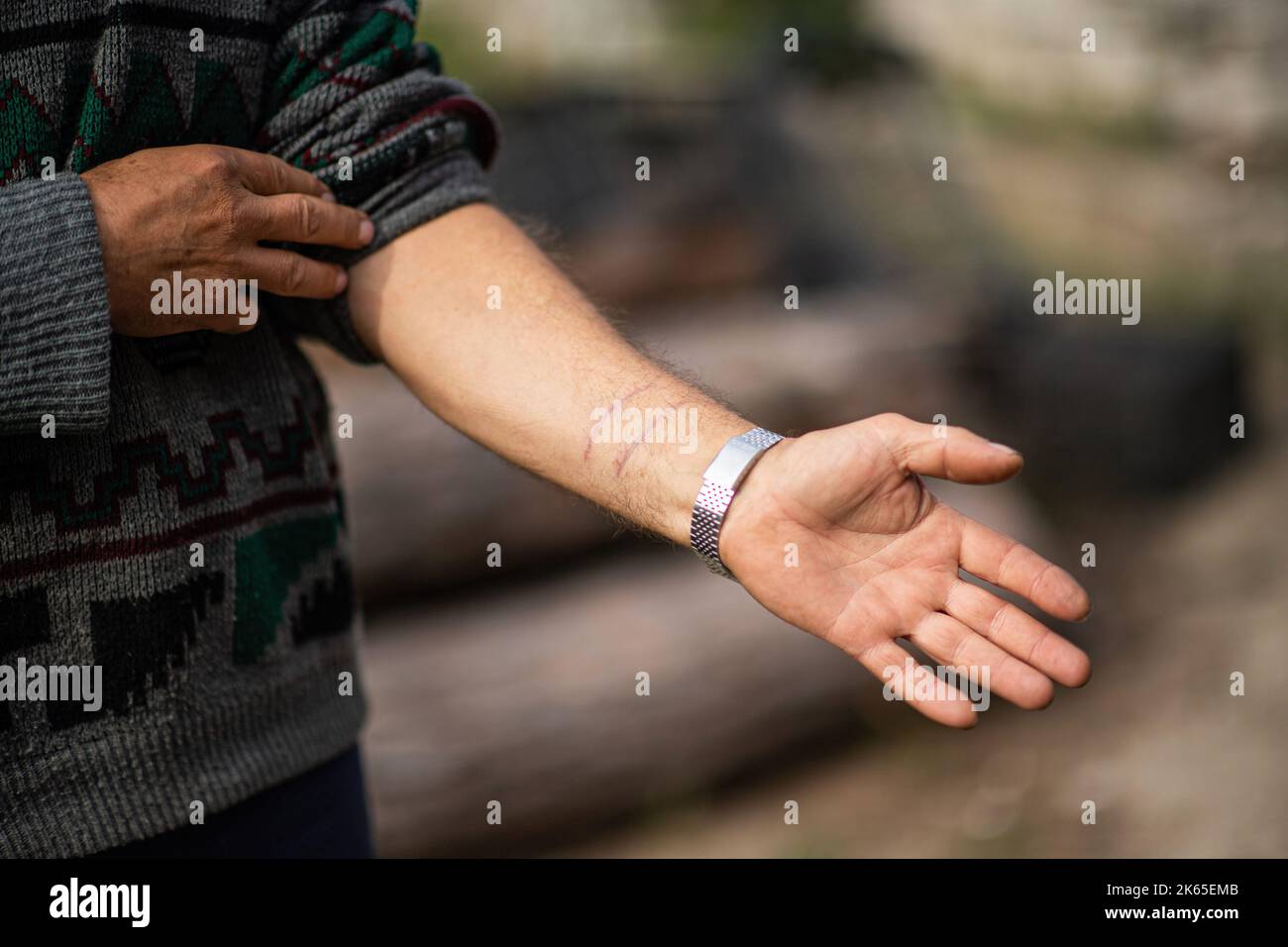 Lyman, Ukraine. 9th Oct, 2022. A resident of Lyman shows the scars he ...