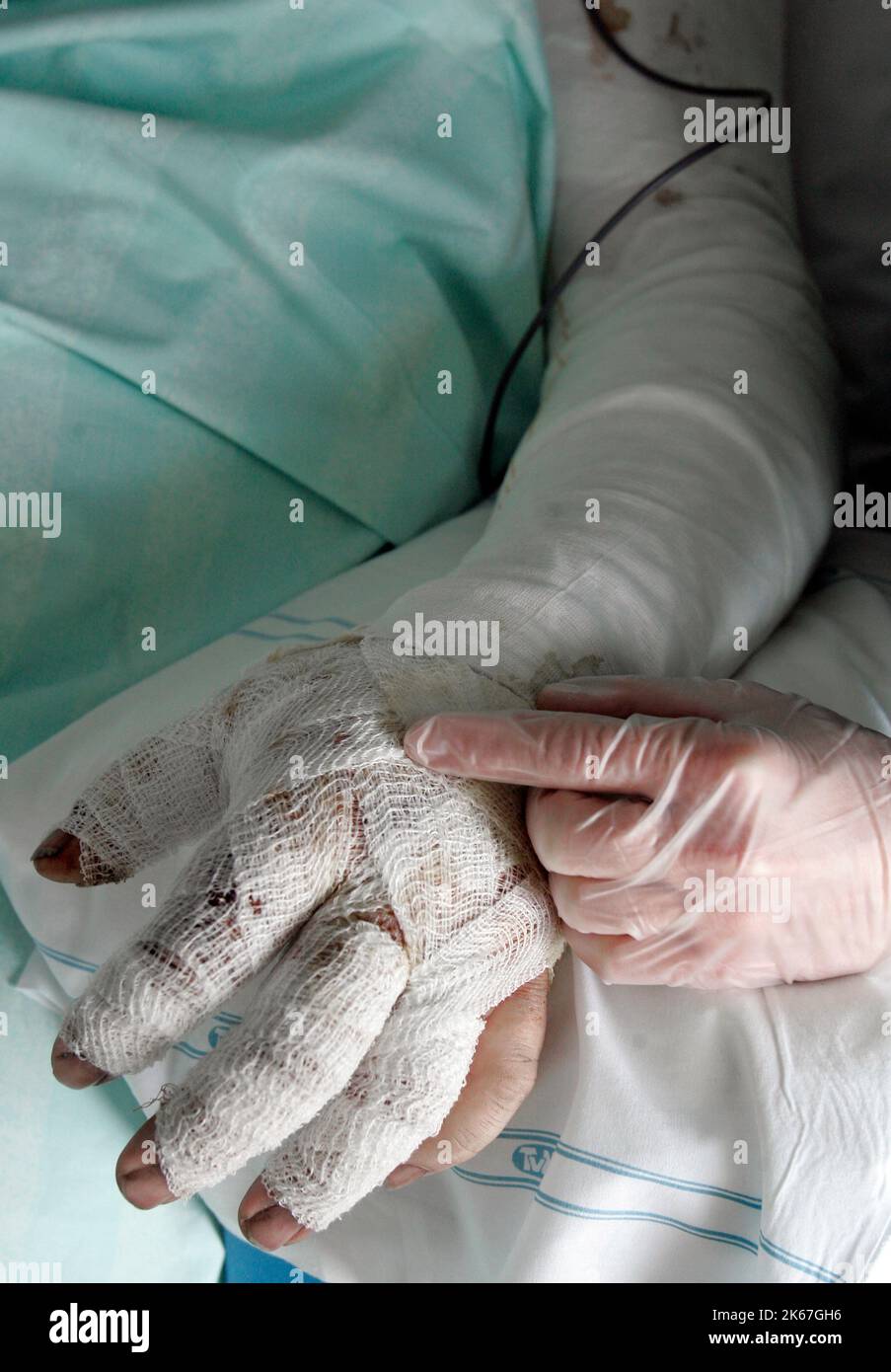 Patient being treated for his burns a burn center, University Hospital ...