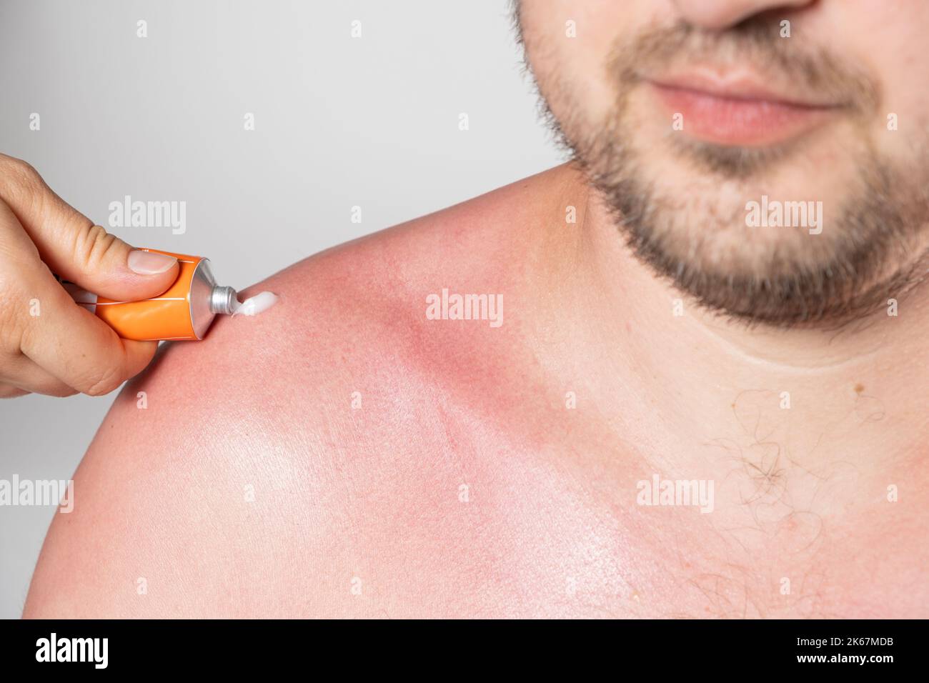 Applying therapeutic ointment to the skin of a person with a sunburn ...