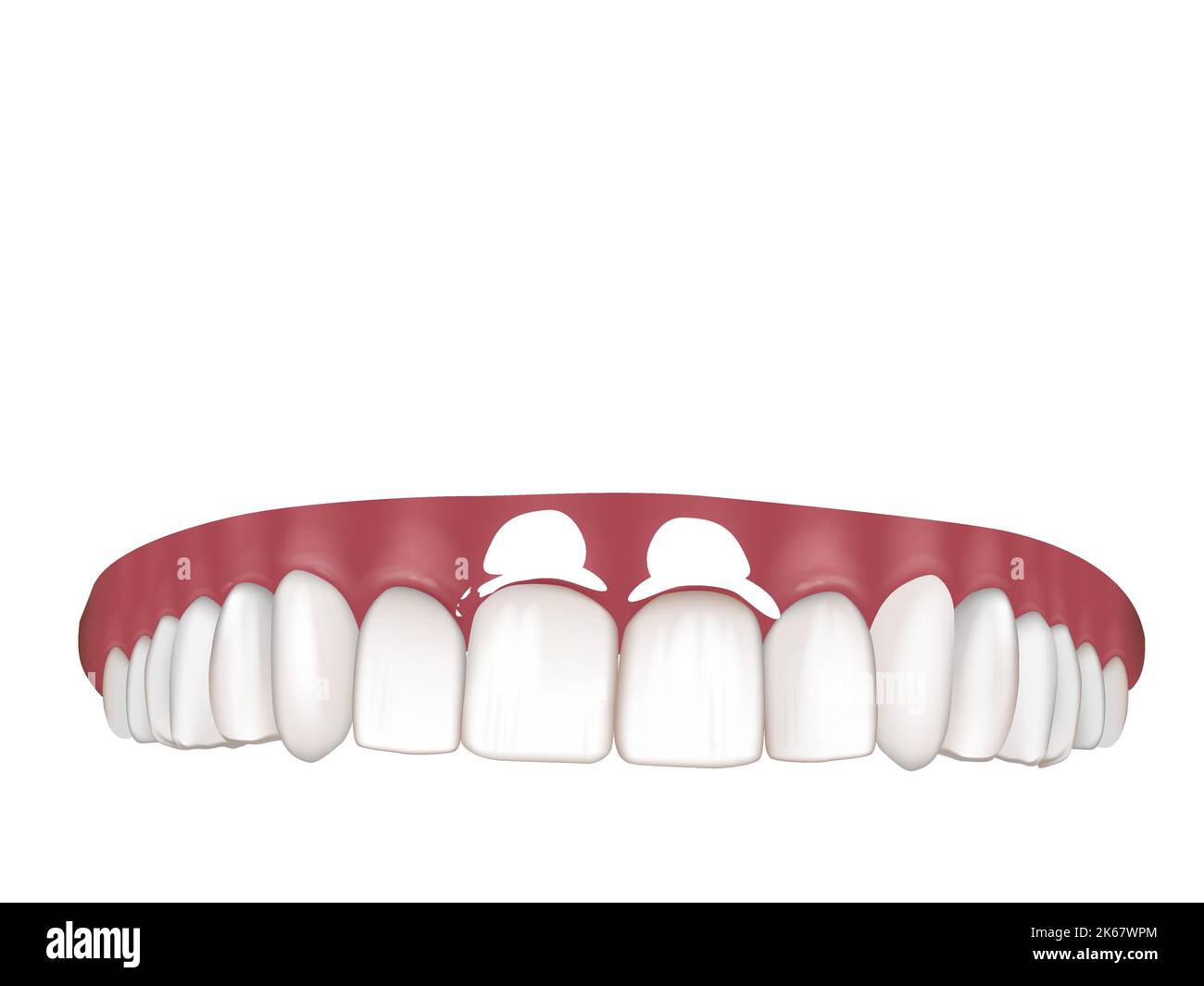 Maxillary Implant Supported Fixed Prosthesis. Maxillary overdentures ...