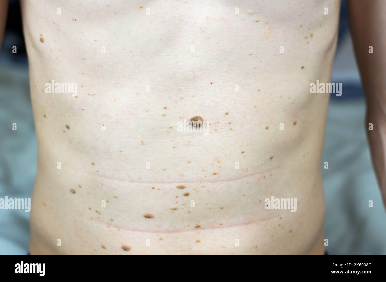 Benign skin pigmentation hi-res stock photography and images - Alamy