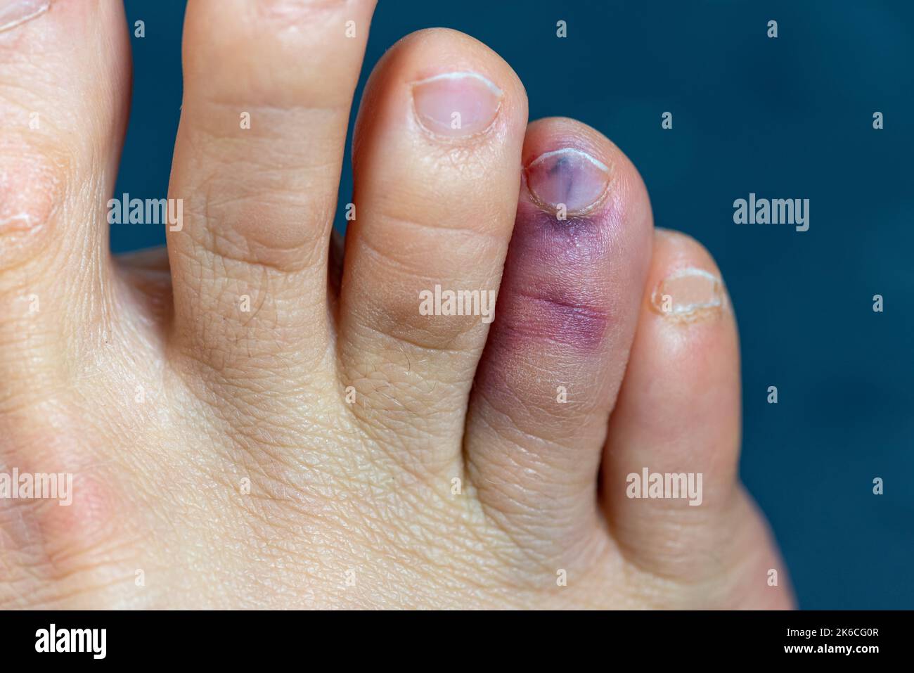 Close-up view of a toe that received a violent blow and turned purple ...