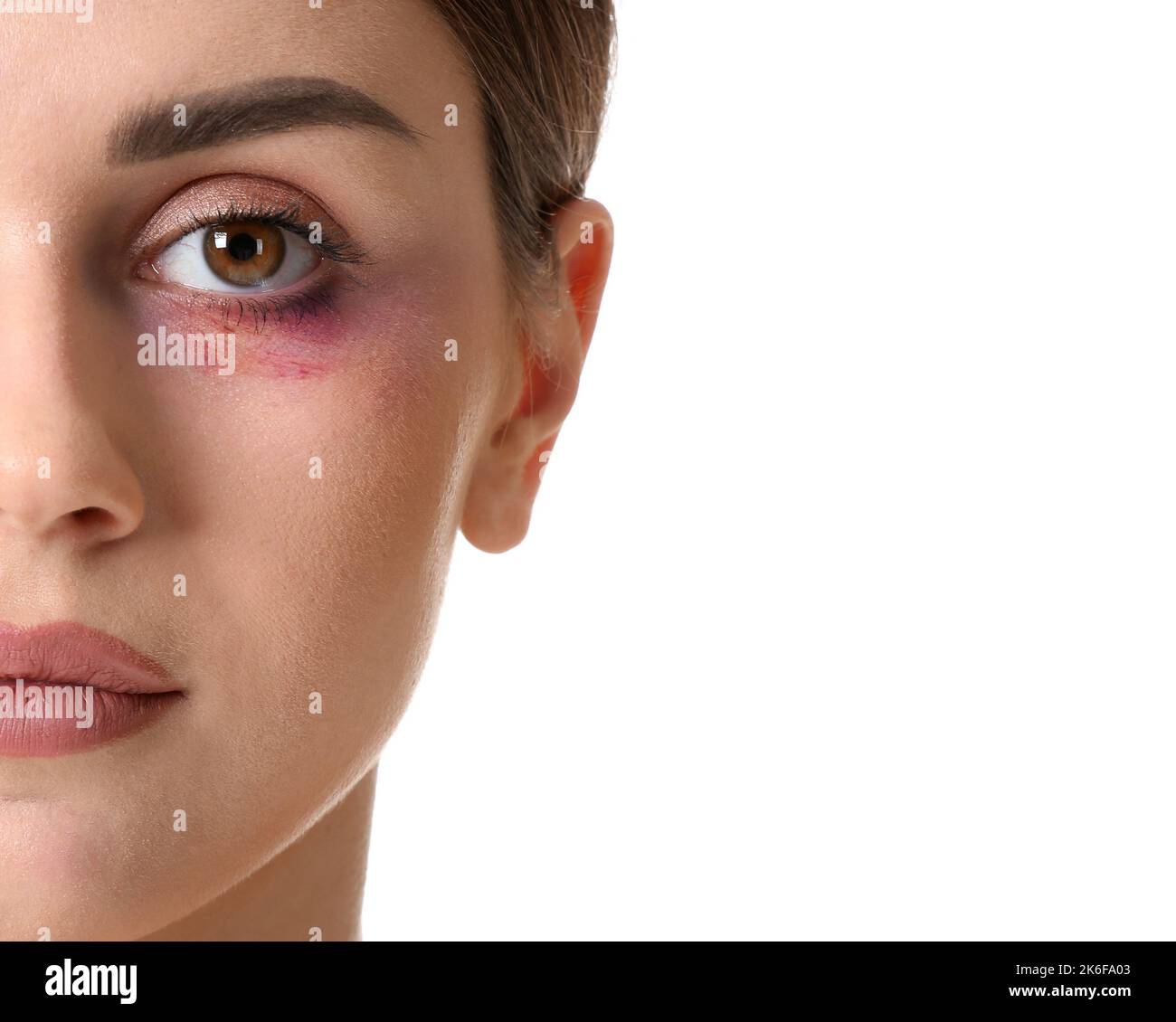 Young woman with bruise under eye on white background, closeup Stock ...