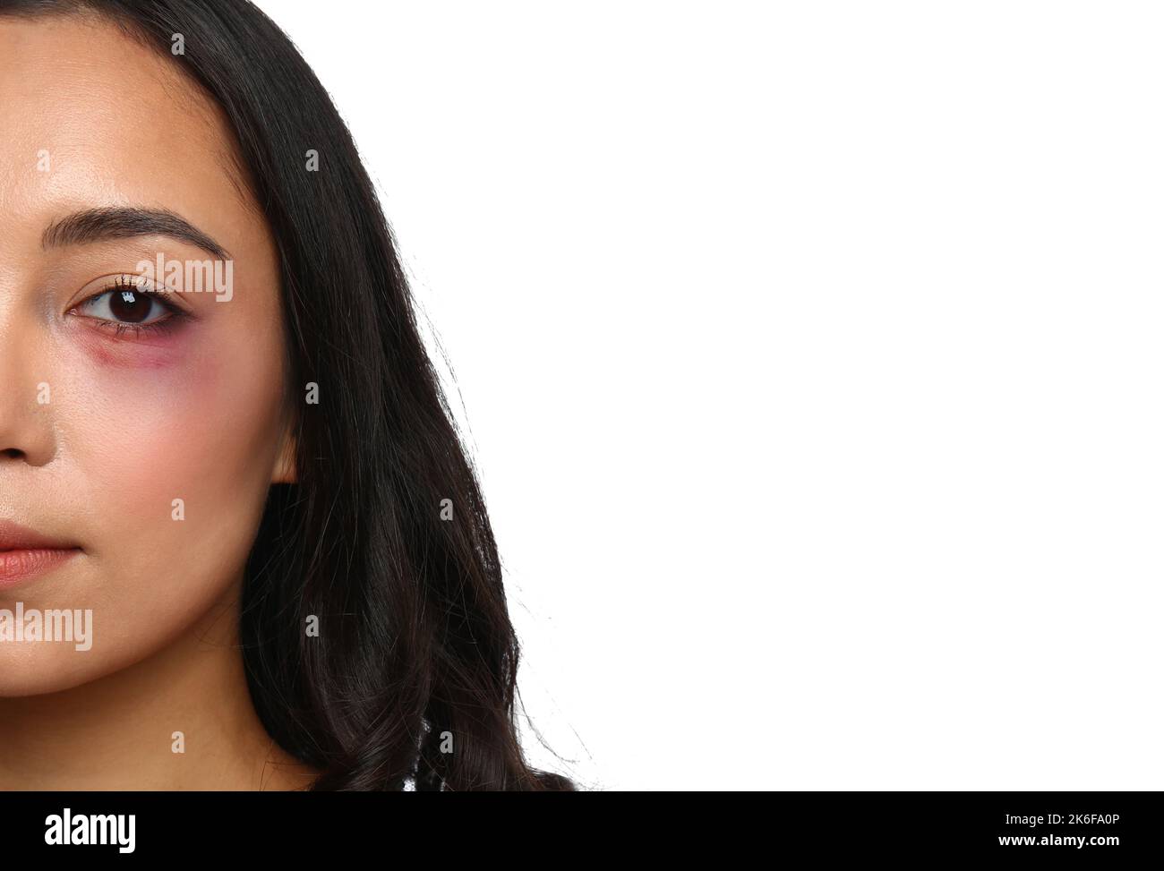 Young woman with bruise under eye on white background Stock Photo - Alamy