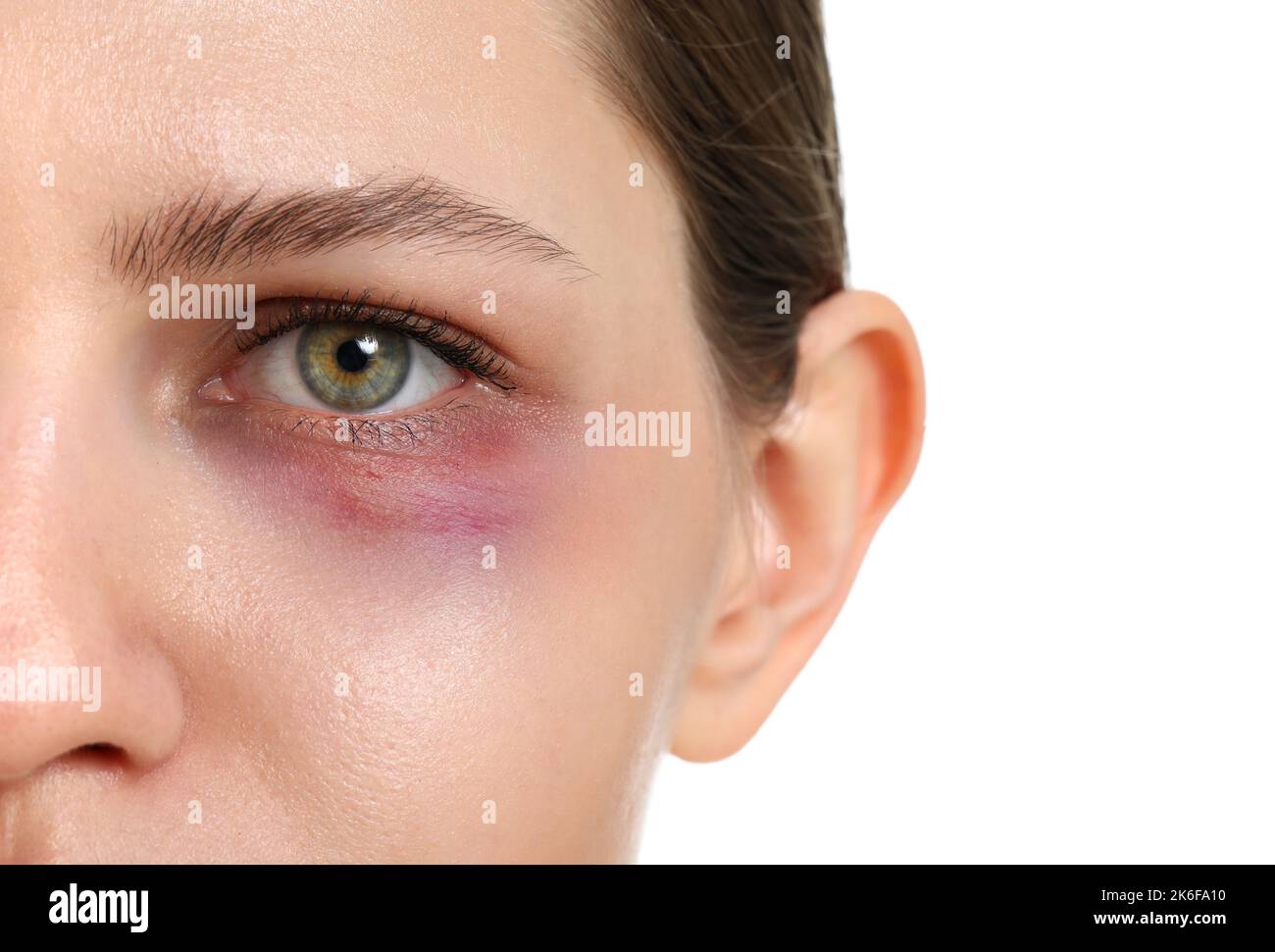 Young woman with bruise under eye on white background, closeup Stock ...