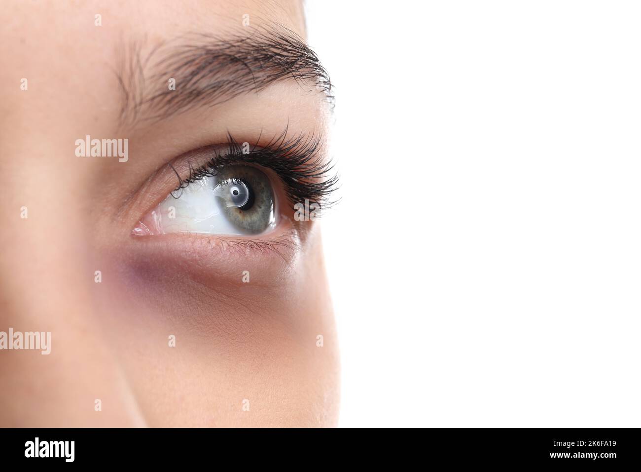 Young woman with bruise under eye on white background, closeup Stock ...