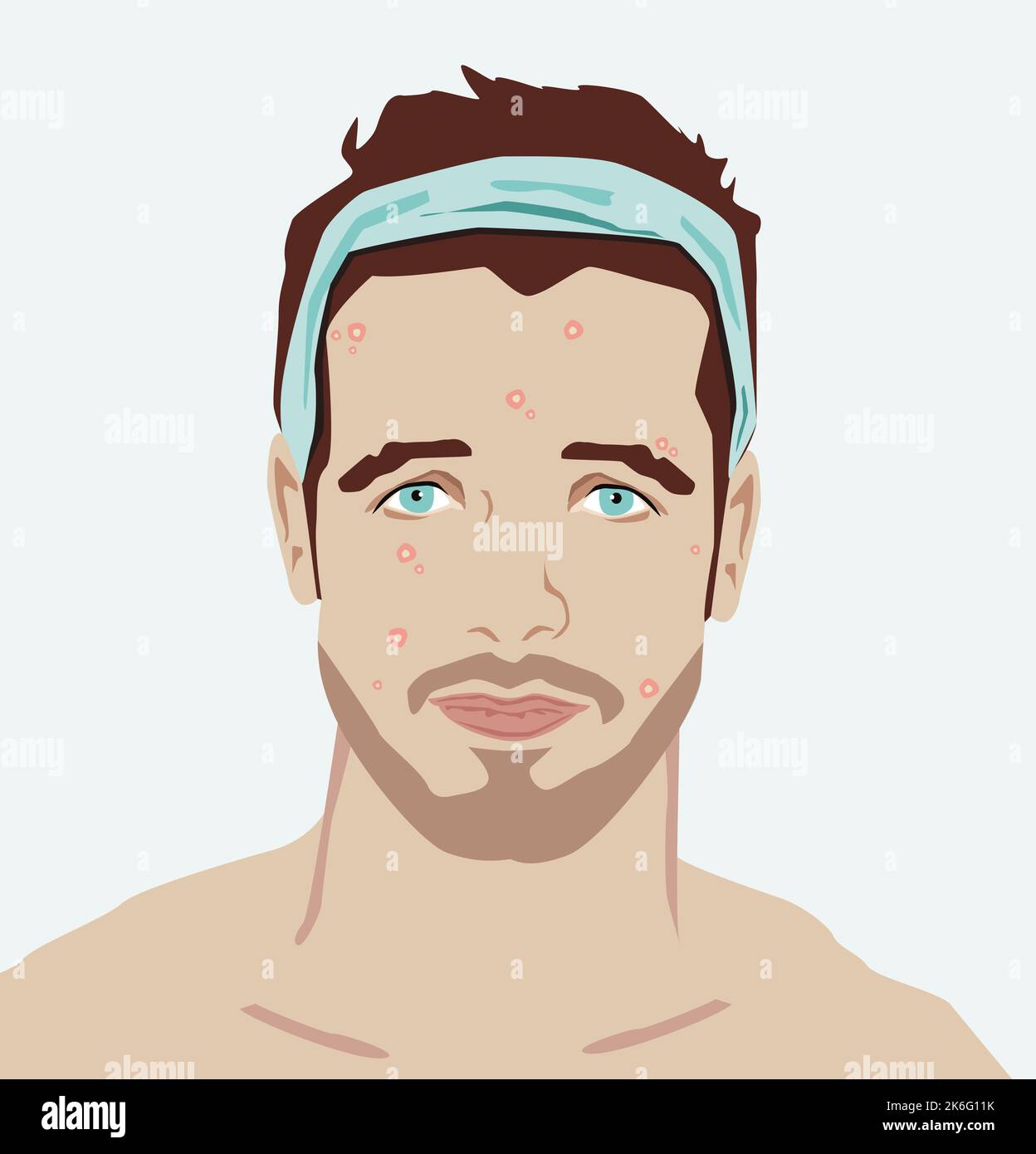 A man with pimples on his face Stock Photo - Alamy