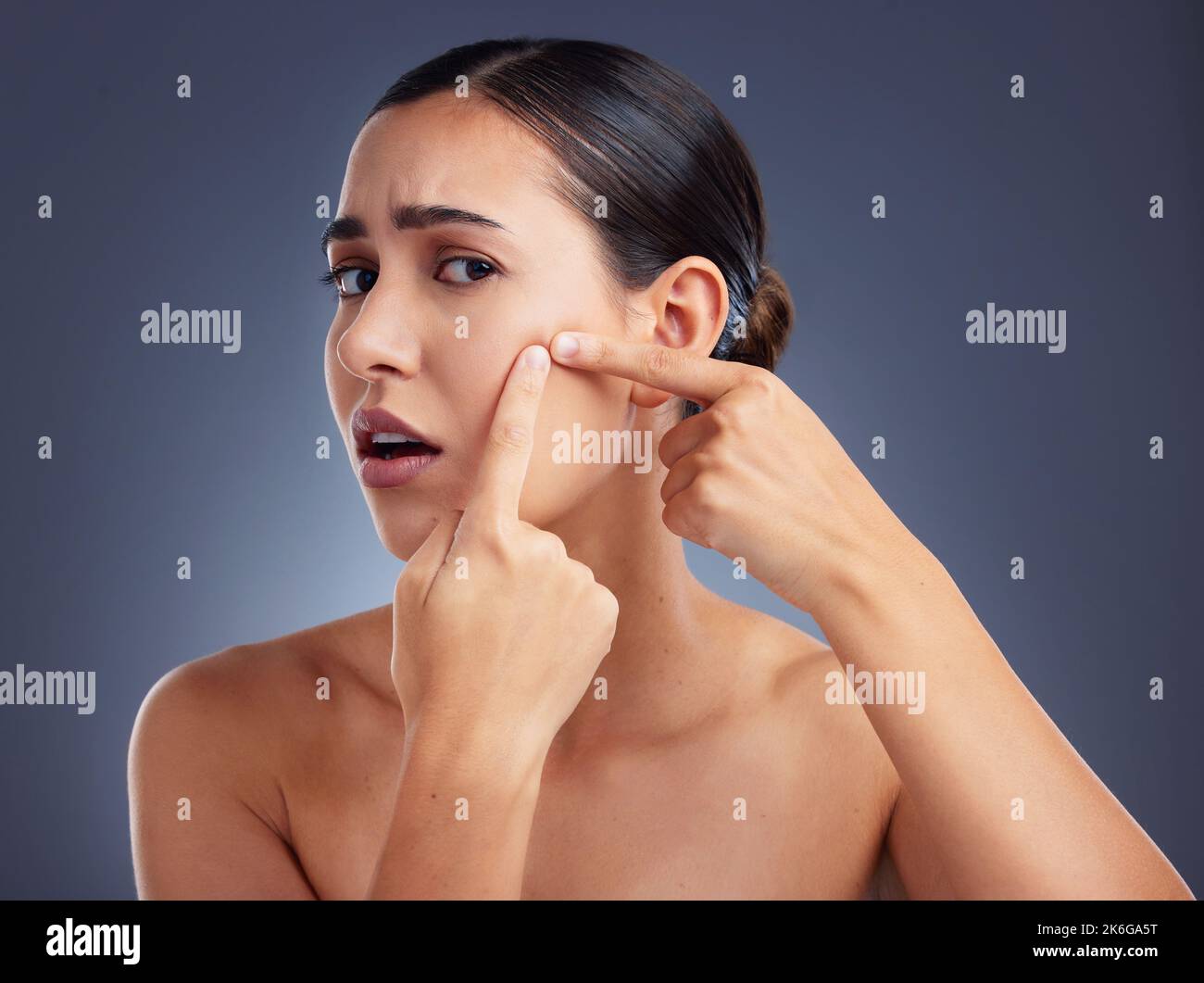 Squeezing pimple zit hi-res stock photography and images - Alamy